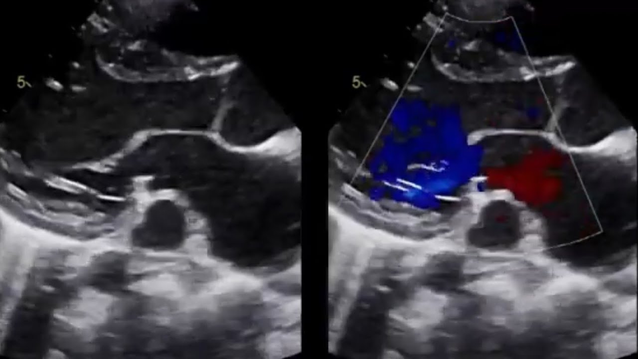 Shone's complex, can you identify the level of obstruction?/ pediatric ...