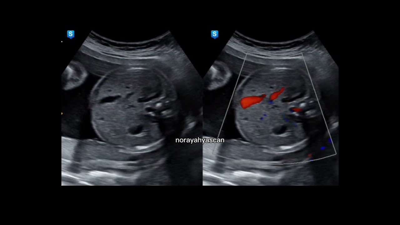 Persistent Rt Umbillical Vein (PRUV) - YouTube