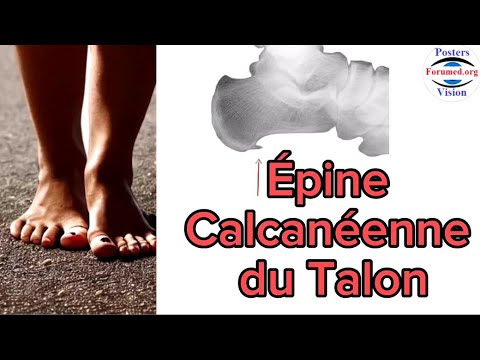 Épine Calcanéenne au Talon douleurs du pied fasciite de Aponévrose ...