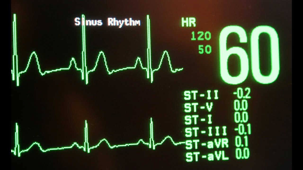 Normal sinus rhythm - YouTube