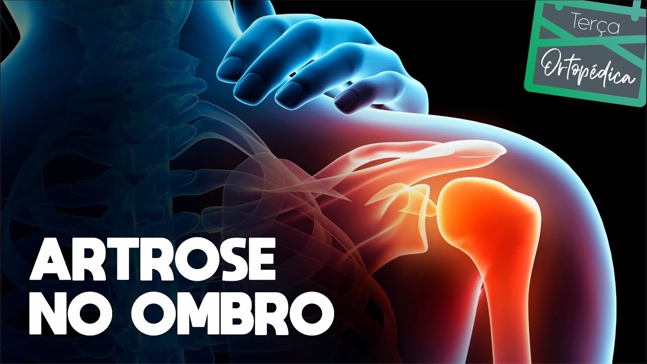 Artrose no Ombro (Dr. Eric Curi - Ortopedista Ombro e Cotovelo) - YouTube