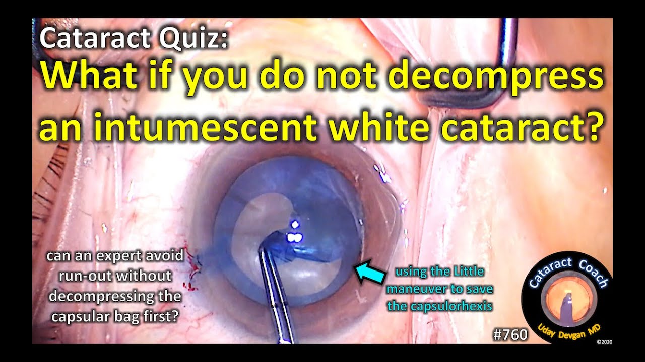 Cataract Quiz: what happens if you do not decompress an intumescent ...