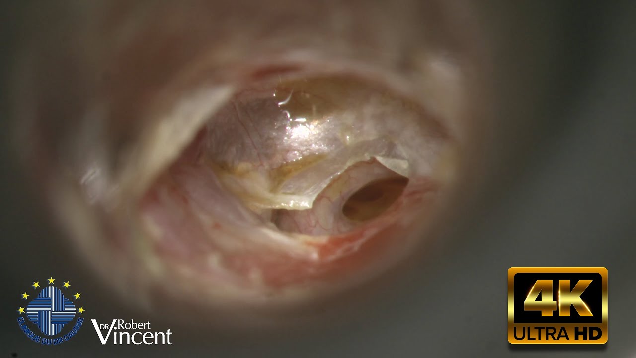 Tympanoplasty with Total Ossicula Chain Reconstruction for Eroded Incus ...