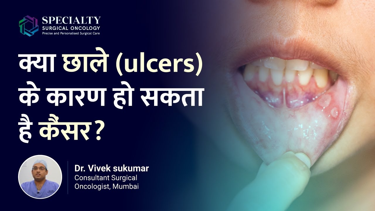 Is it true that ulcers cause cancer? - Learn from cancer specialist ...