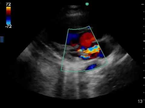 11 y.o. Girl with Fever Of Unknown Origin x 2 weeks with 1 day of Confusion