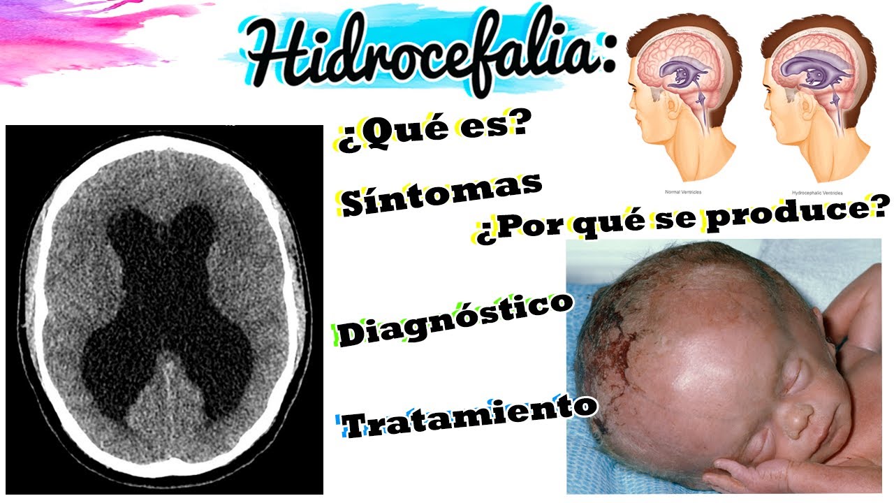 HIDROCEFALIA - CASO CLÍNICO - Fisiopatología - Síntomas - Diagnóstico ...