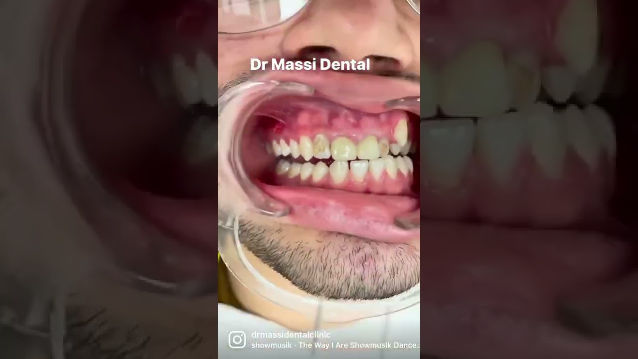 What is a parulis or Fistula? - YouTube