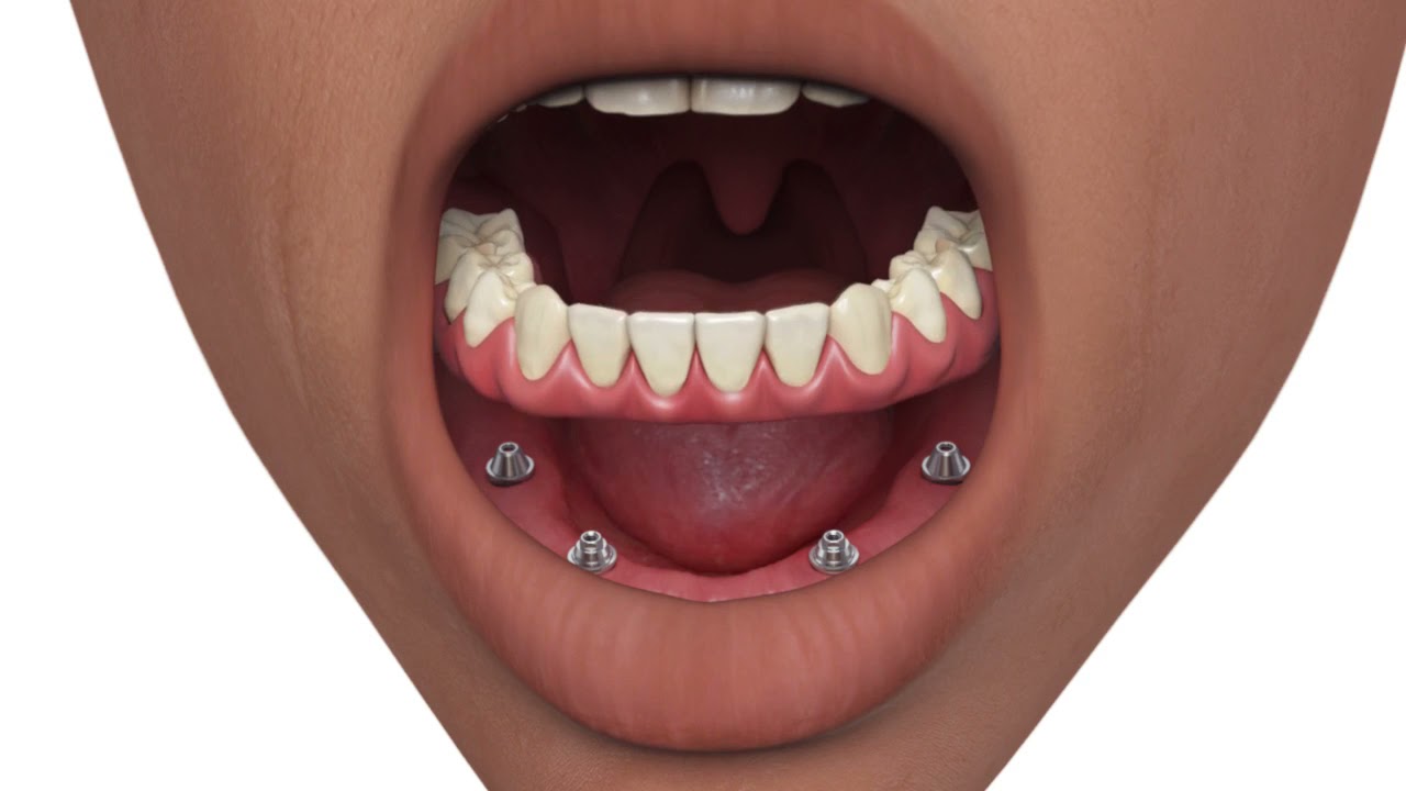 Multi unit abutment open tray technique using the direct pick up coping ...