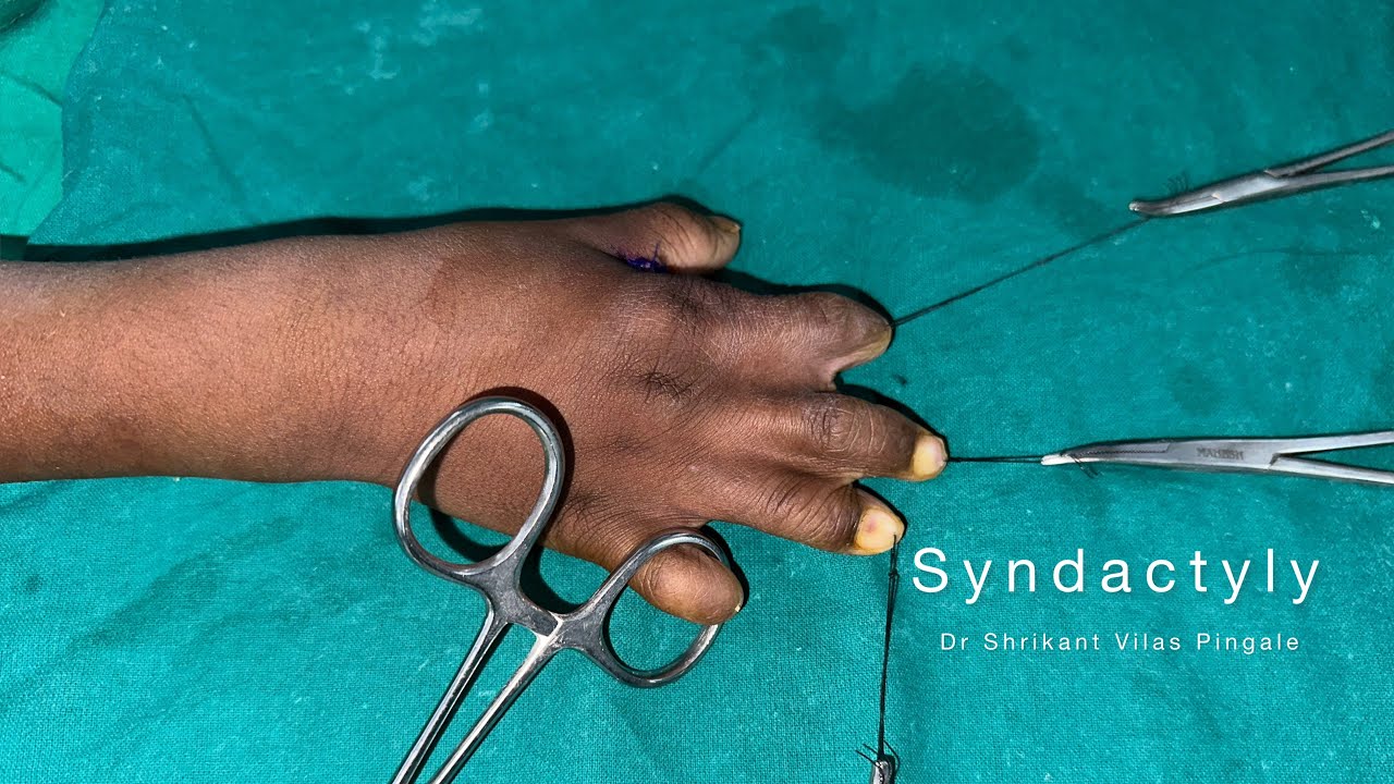 Syndactyly Release of Fingers Webbing - YouTube