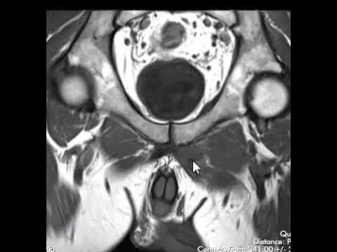Sports hernia with adductor longus tendon tear - YouTube