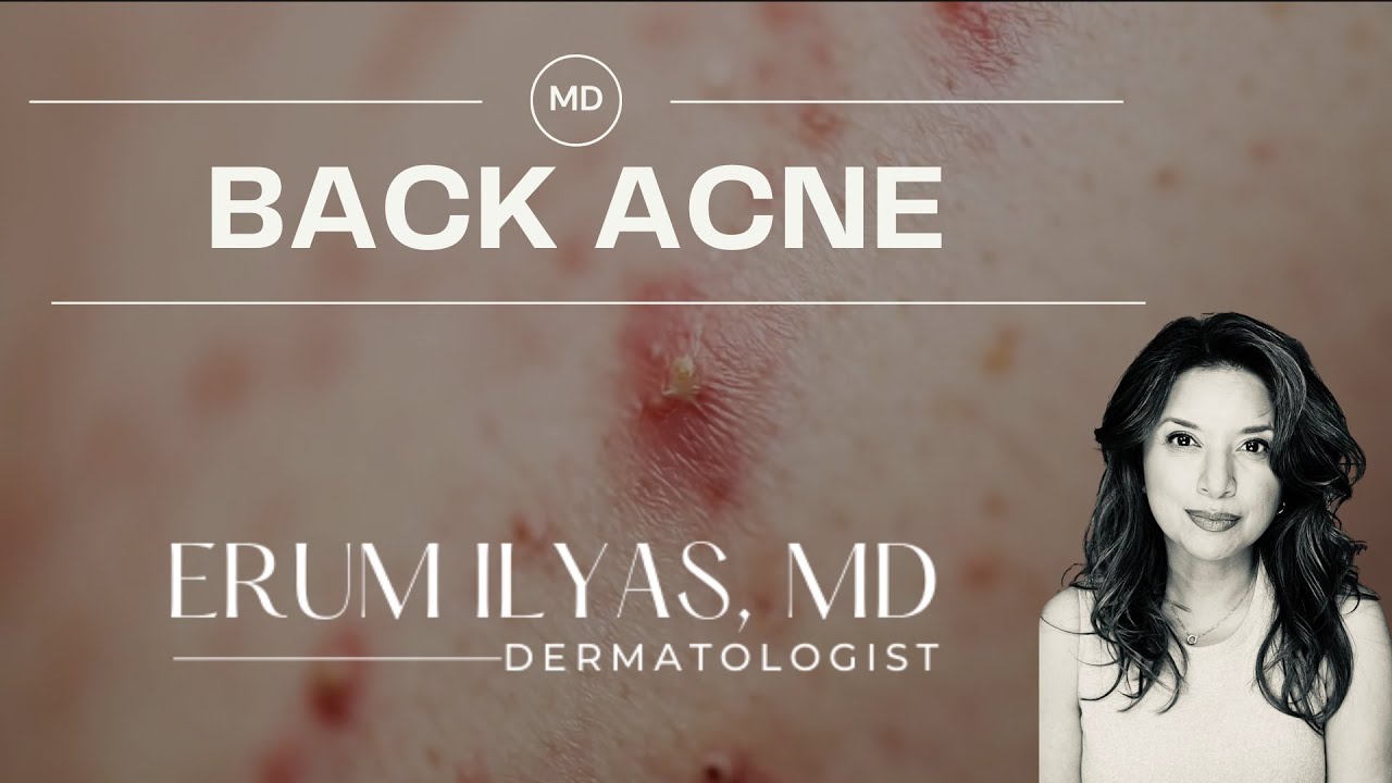Back Acne | Breakouts on the Back - YouTube