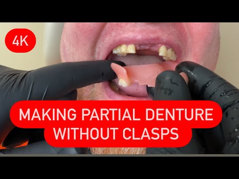 How To Make Your Own Partial Denture