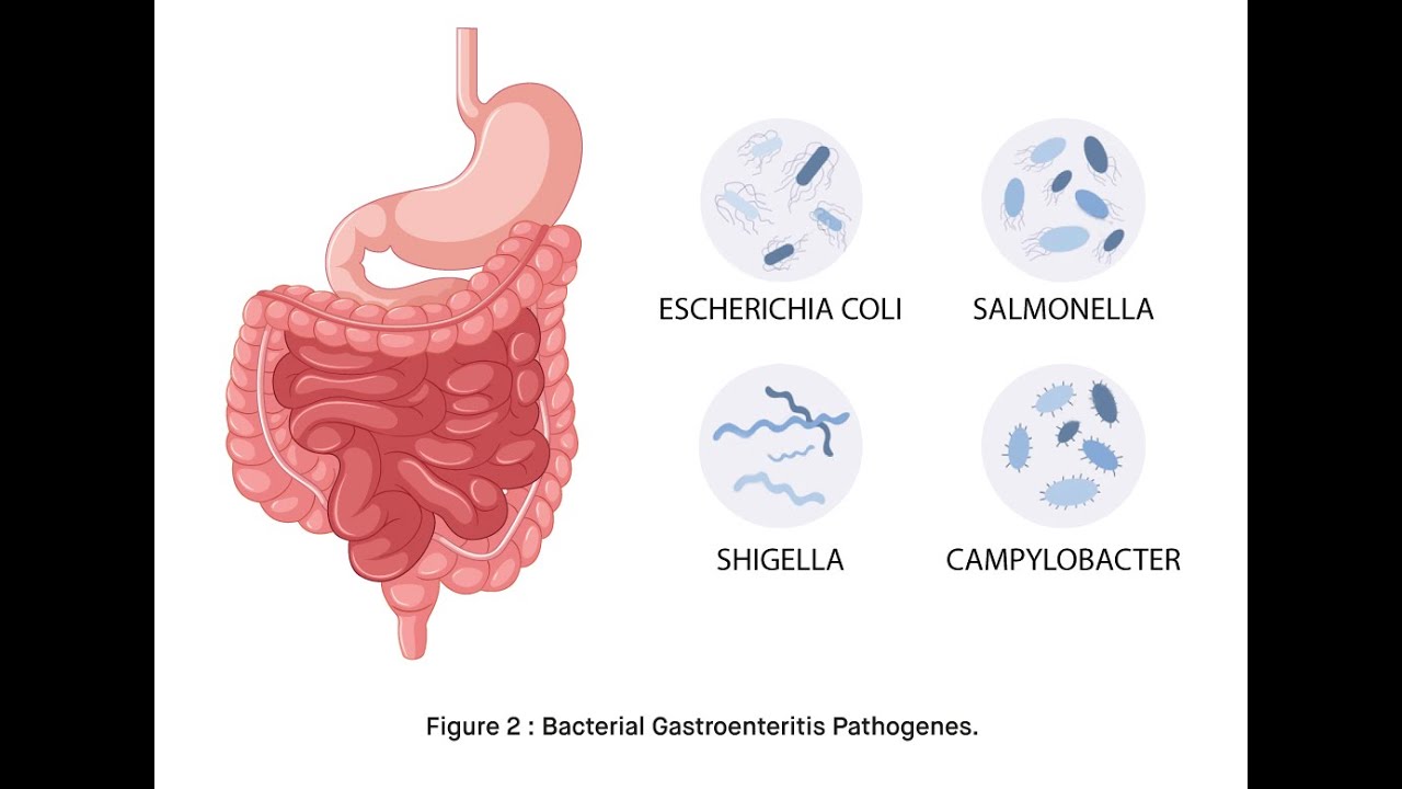 Bacterial Gastroenteritis ; Definition, Causes, Symptoms, Diagnosis ...