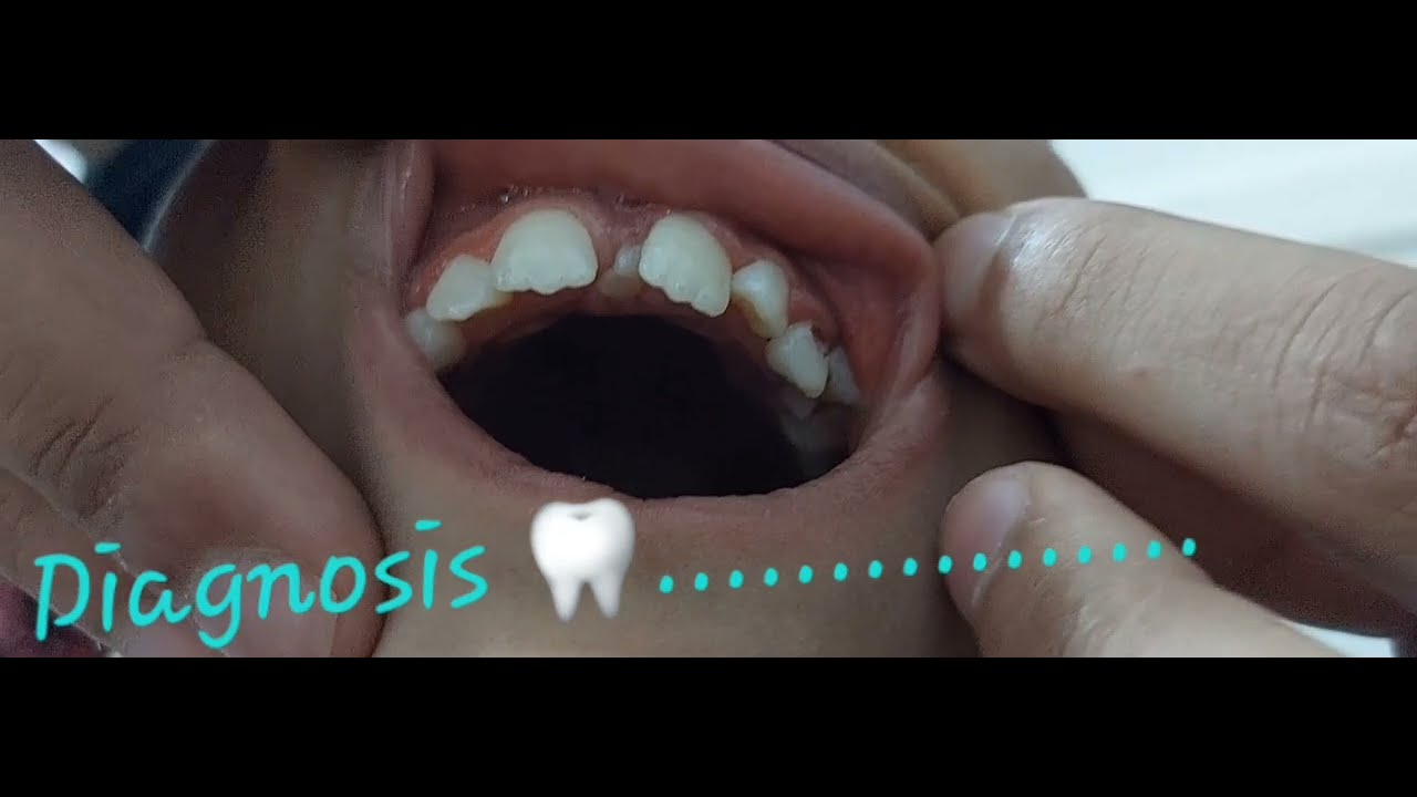 What is your diagnosis?? [3] teeth abnormalities in children causing impaired malocclusion - YouTube