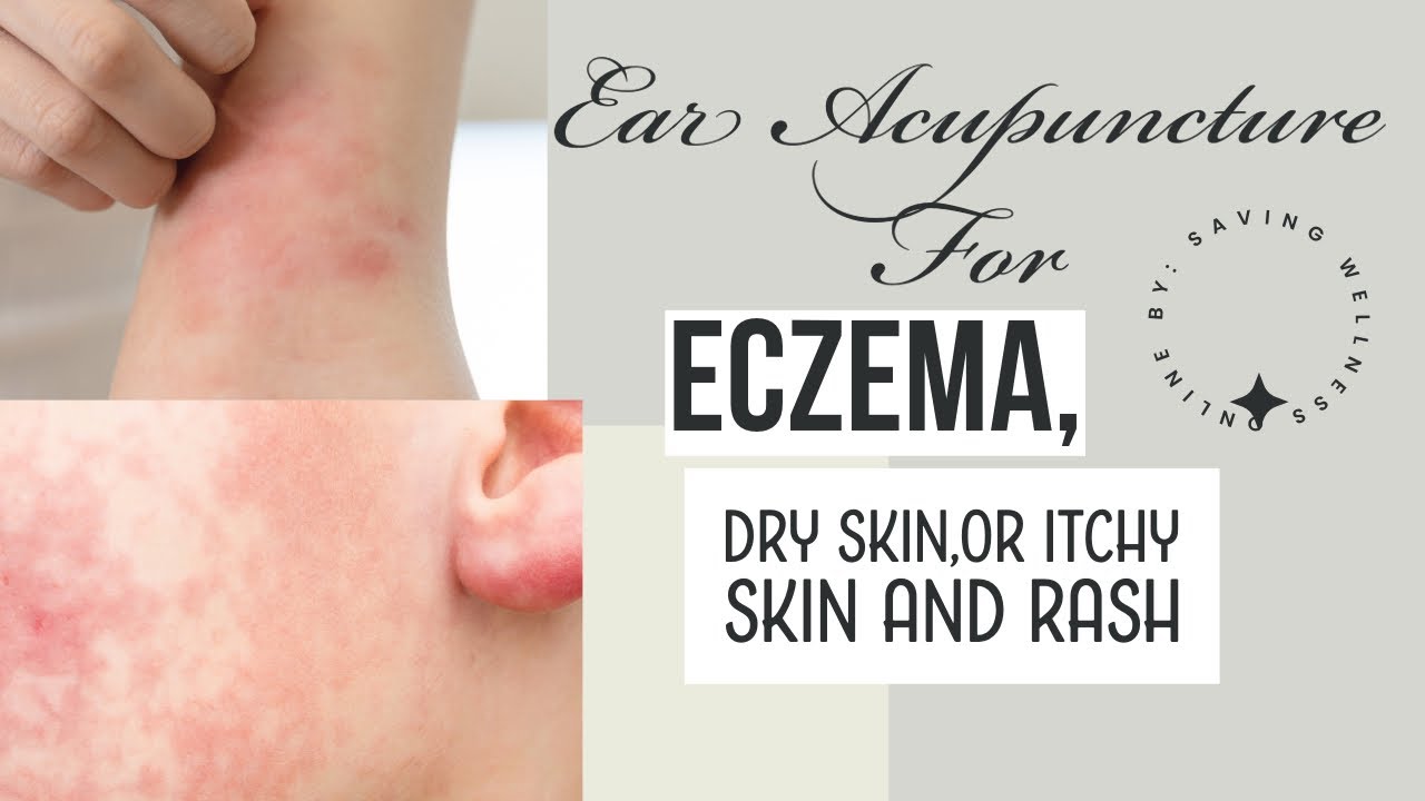 For Skin Problems Itching Eczema - Self Ear Acupressure Acupuncture ...