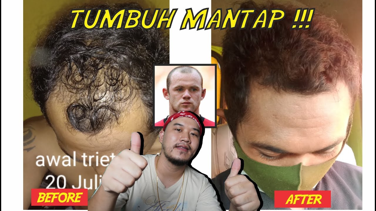 AJAIB!! CARA MENUMBUHKAN RAMBUT BOTAK SAMPING atau BOTAK M atau SULAK ...