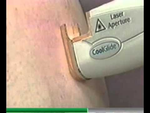 Laser Hair Removal Miami (Electrolysis vs. Laser Hair Removal) - YouTube