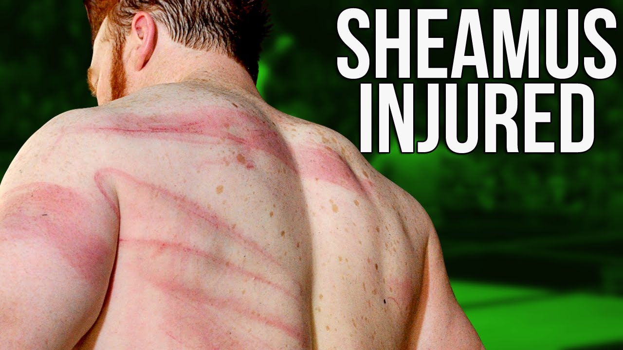 WWE SHEAMUS INJURED! OUT OF ACTION! - YouTube