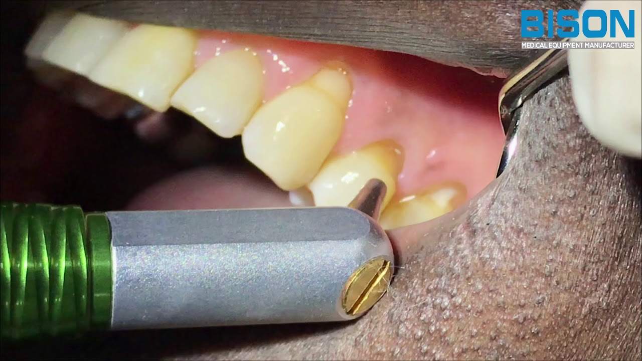 Bison Cyma CO2 Laser desensitizing - YouTube