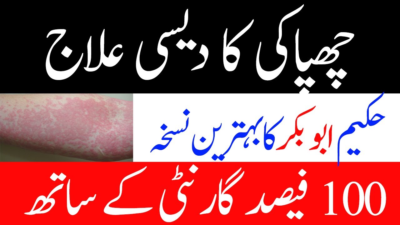 chapaki ka desi ilaj - chapaki ka ilaj - urticaria treatment ...