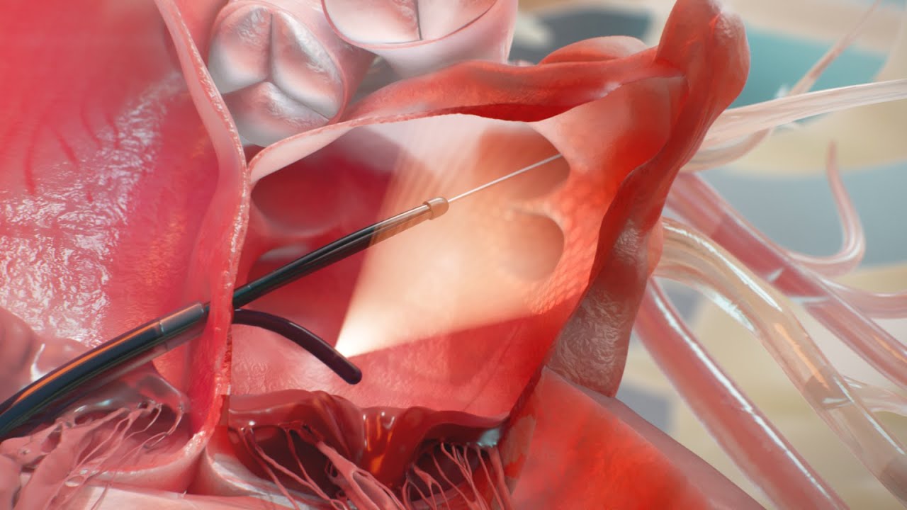 Step-by-Step: How 4D ICE supports PFA and LAAC procedures - YouTube