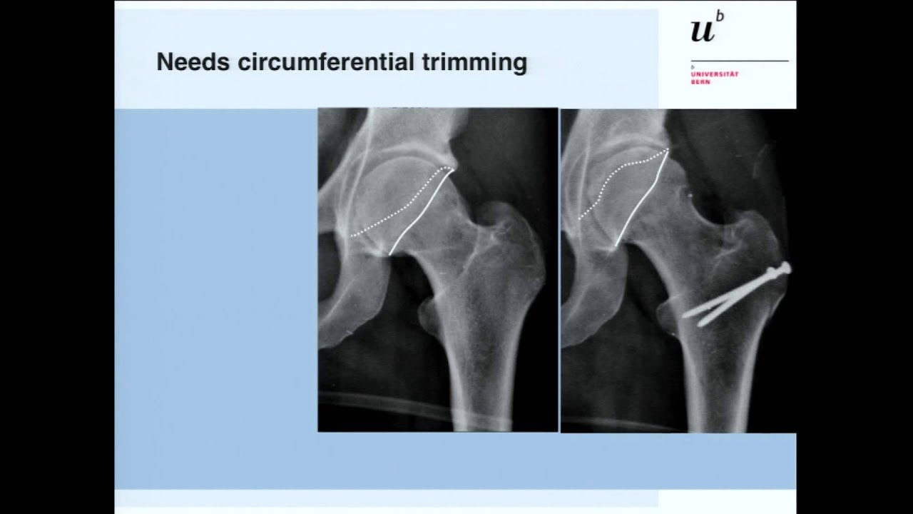 Planning of acetabular rim trimming by K-A. Siebenrock (CH) - YouTube