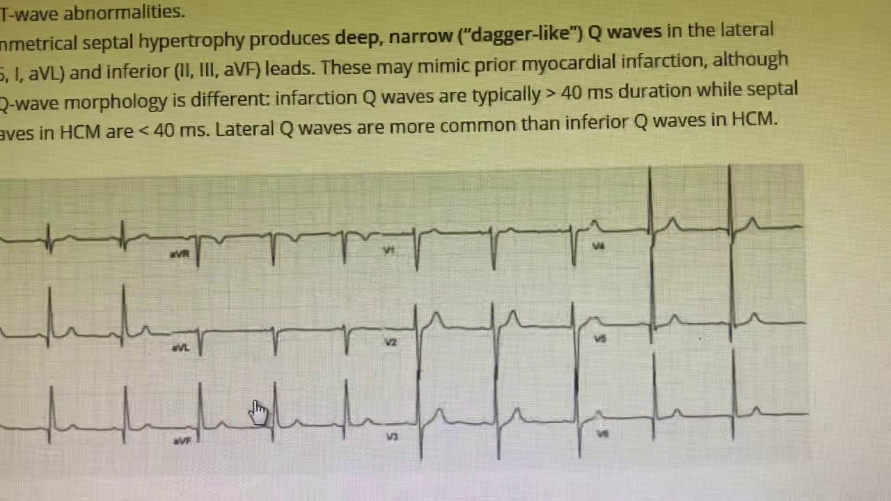 ECG changes in HCM - YouTube