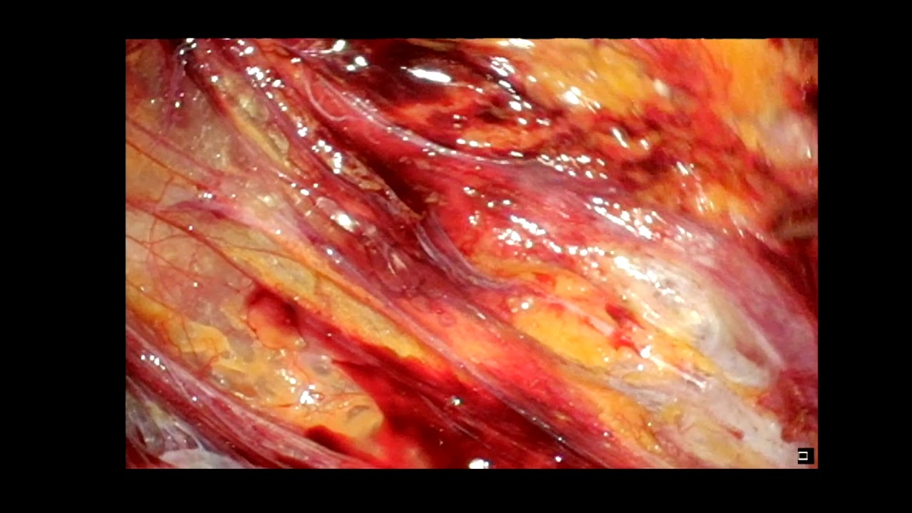 Lap TEP Bilateral - YouTube