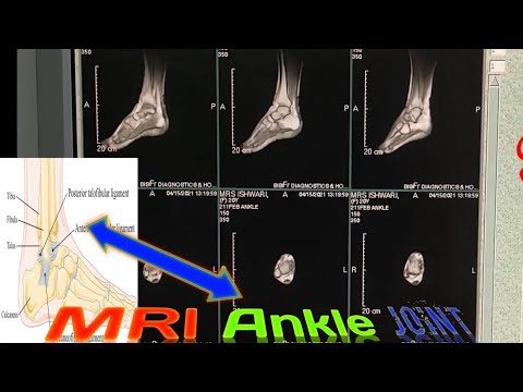 How to Do of Ankle joint MRI planning /Anatomy of Ankle Joint/ Ankle ...