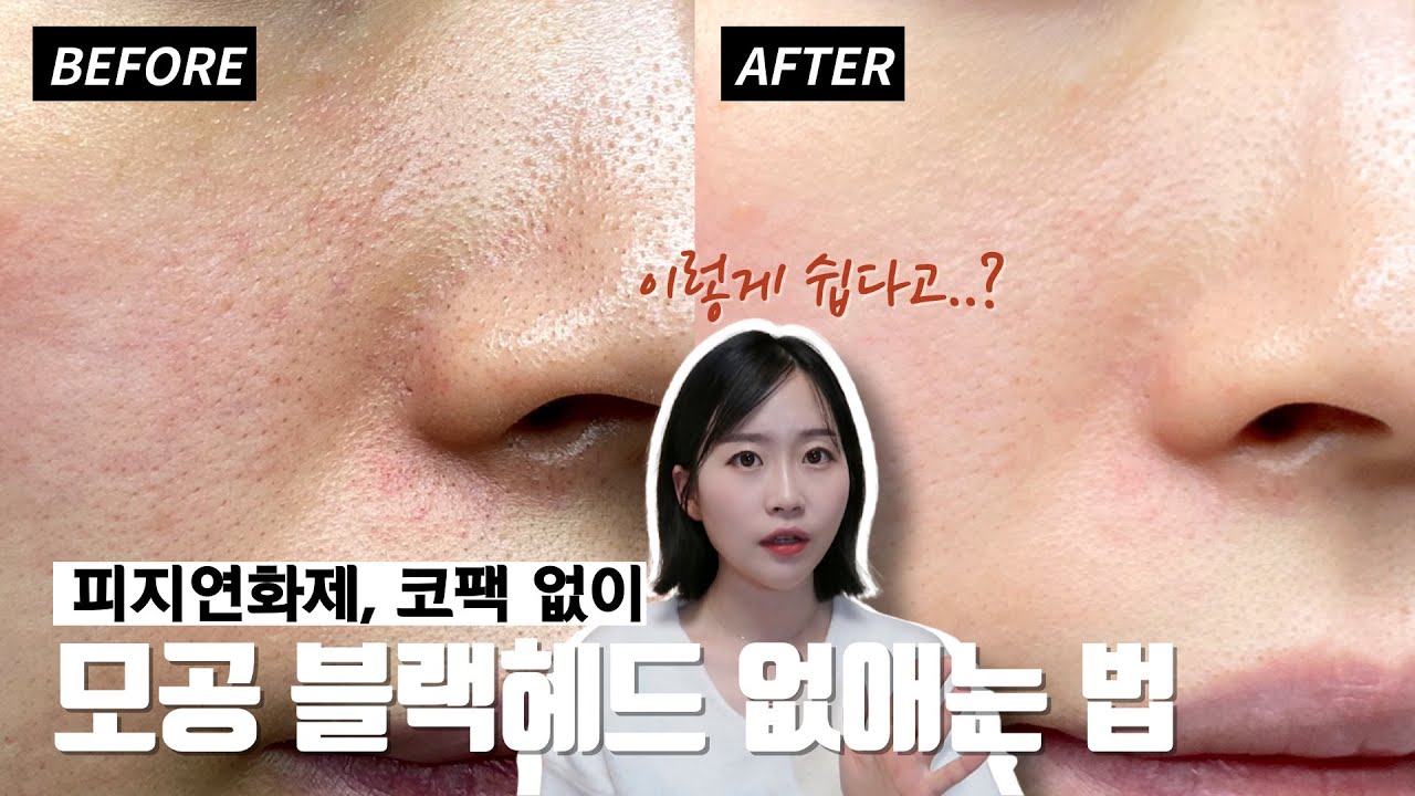 피지연화제 손절한 모공근본템? 가장쉽고 간단하게 모공 줄이는 방법 ｜How to get rid of Blackhead - YouTube
