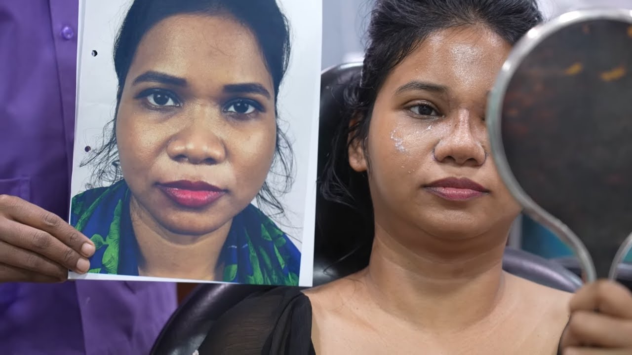 Rhinoplasty | Nose Job Before After Experience - India - YouTube