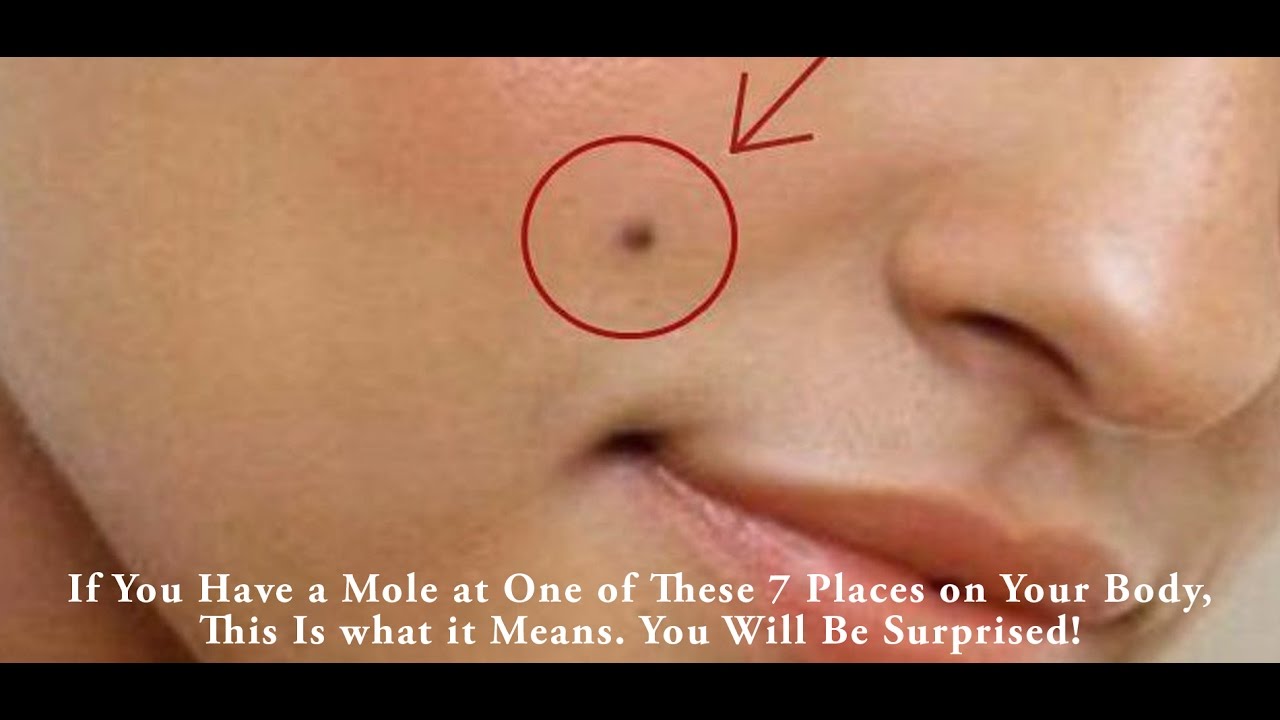 If You Have a Mole at One of These 7 Places on Your Body, This Is what ...