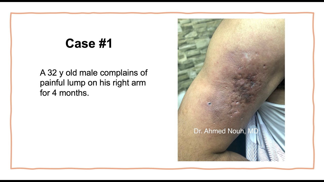 lupus profundus & Lupus tumidus; Clinical and pathological perspectives ...