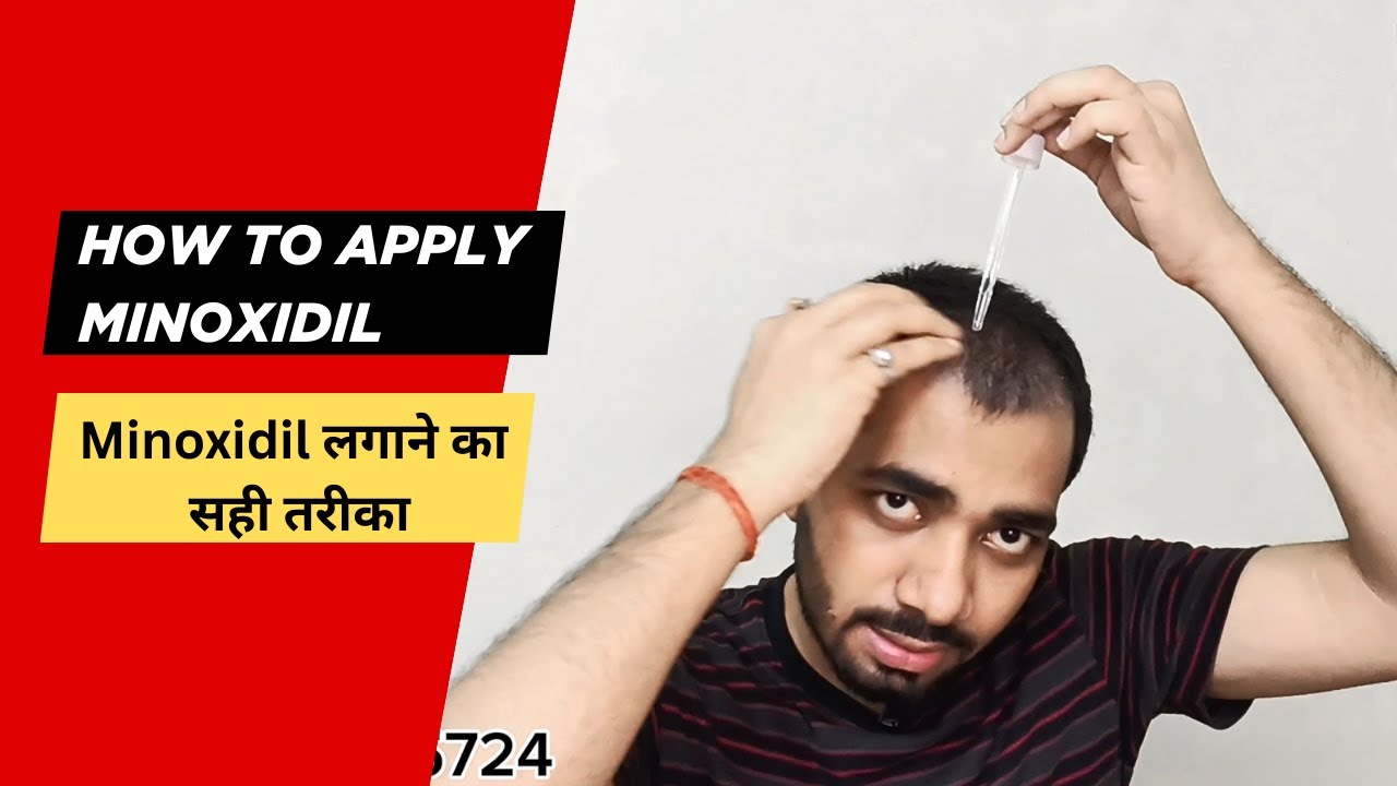 How to apply Minoxidil | Morr 5% Minoxidil growth result | Density Hair ...