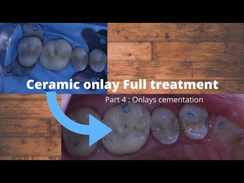 Ceramic onlay full treatment - Part 4 : Onlays cementation - YouTube