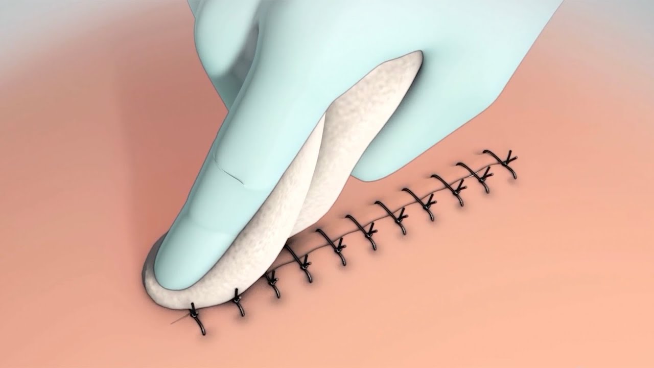 Instrucciones del alta para el cuidado de la incisión - YouTube