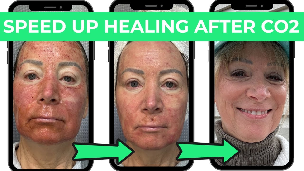 How Can I Speed Up Healing After Co2 Laser? How Long After Co2 Laser ...