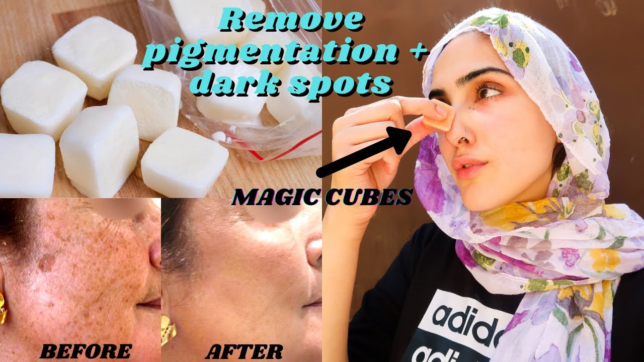How To REMOVE DARK SPOTS, PIGMENTATION + MELASMA AT HOME *NATURAL ...