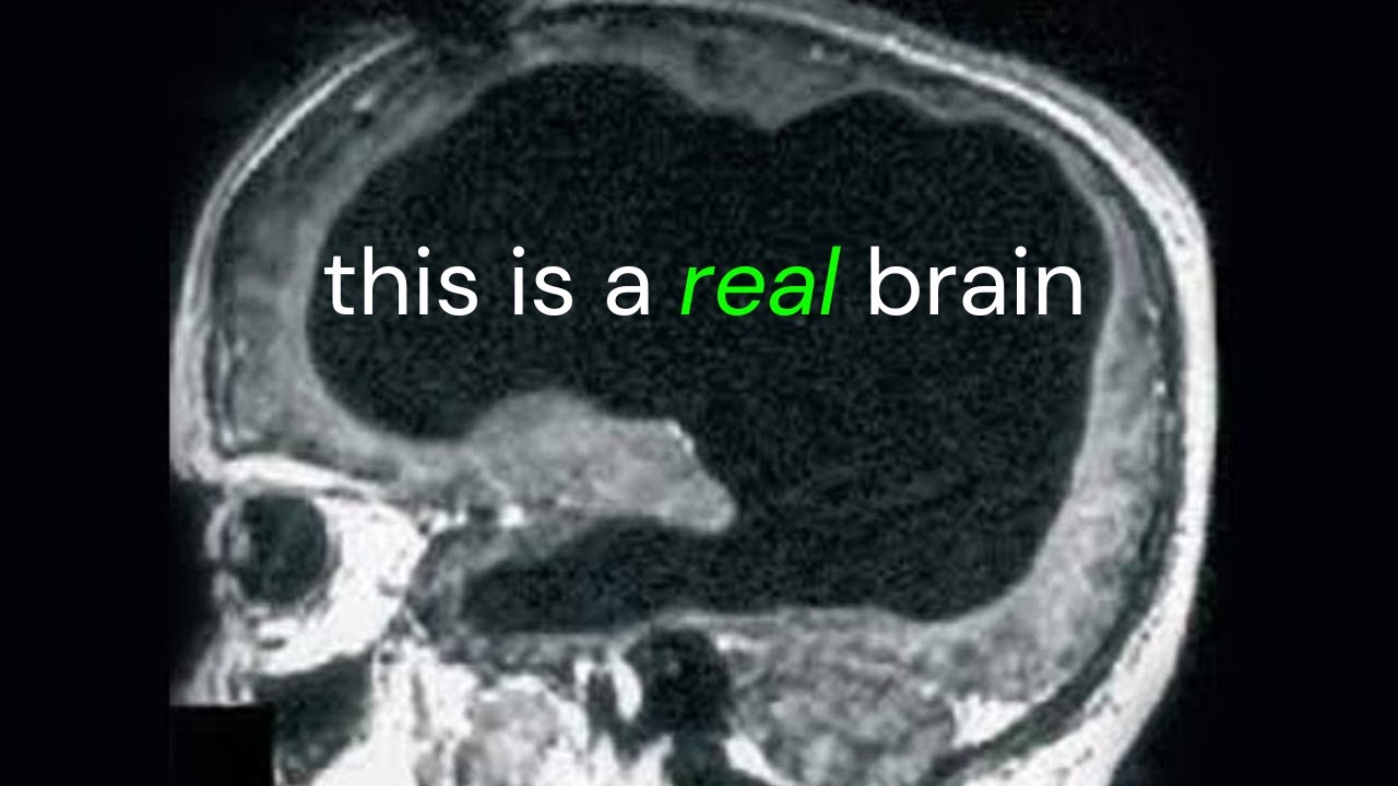 You can live without a LOT of your brain - YouTube