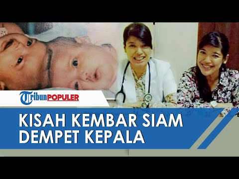🔴 Kisah Yuliana-Yuliani, Kembar Siam Dempet Kepala yang Berhasil Operasi di Indonesia Tahun 1987
