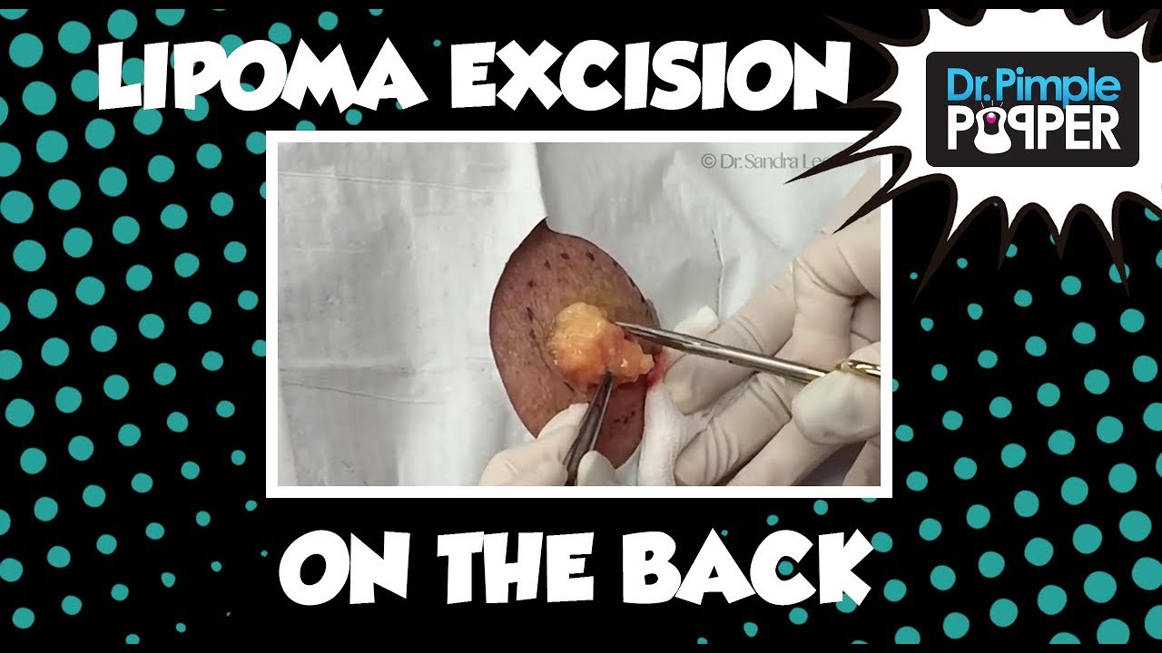 Lipoma excision, Upper Back - YouTube