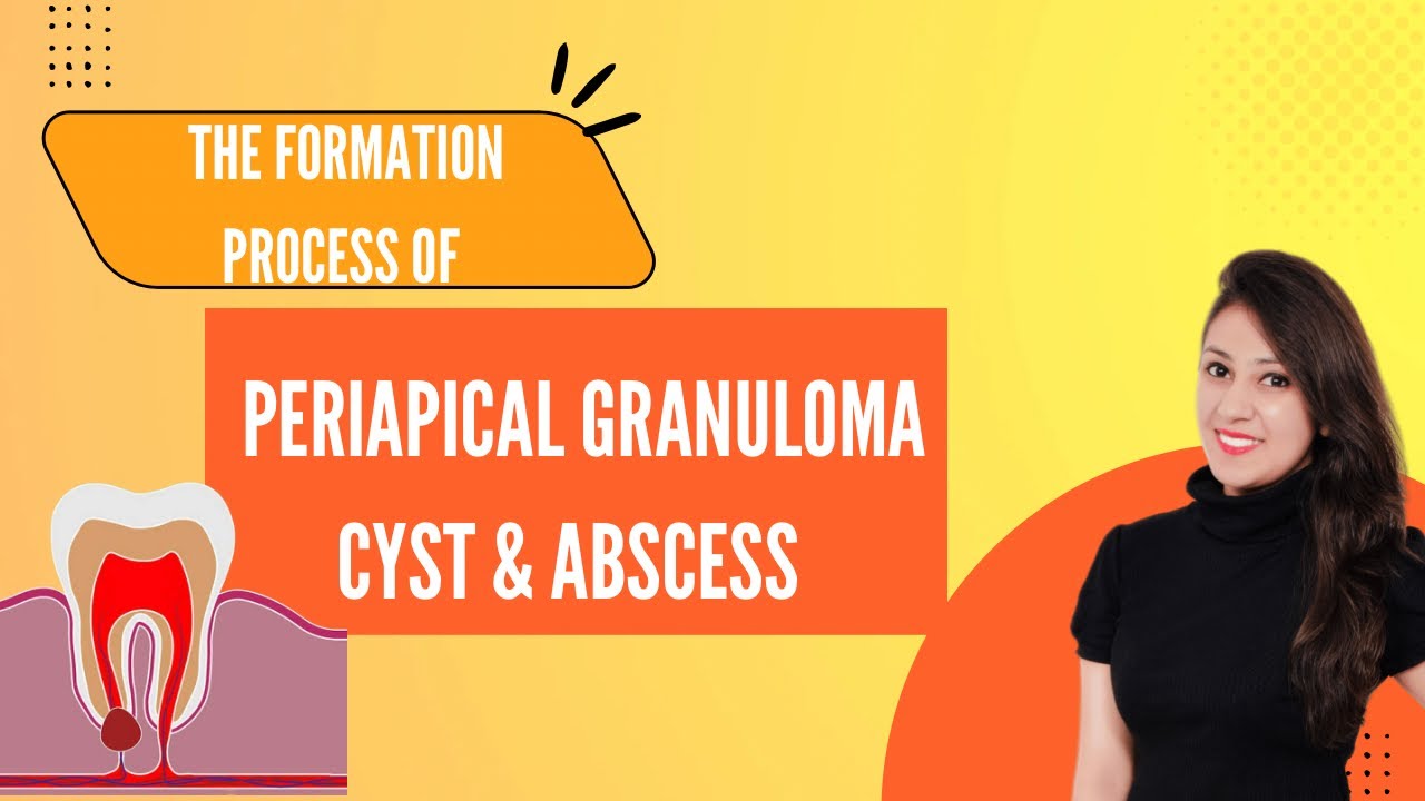 FORMATION PROCESS OF PERIAPICAL GRANULOMA ,CYST & ABSCESS| SIMPLIFIED ...