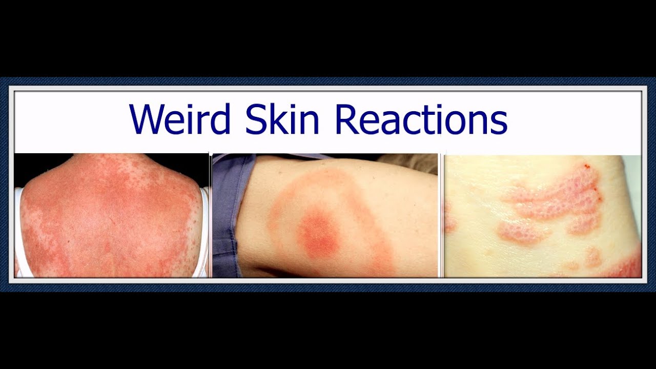 Weird Skin Reactions - YouTube