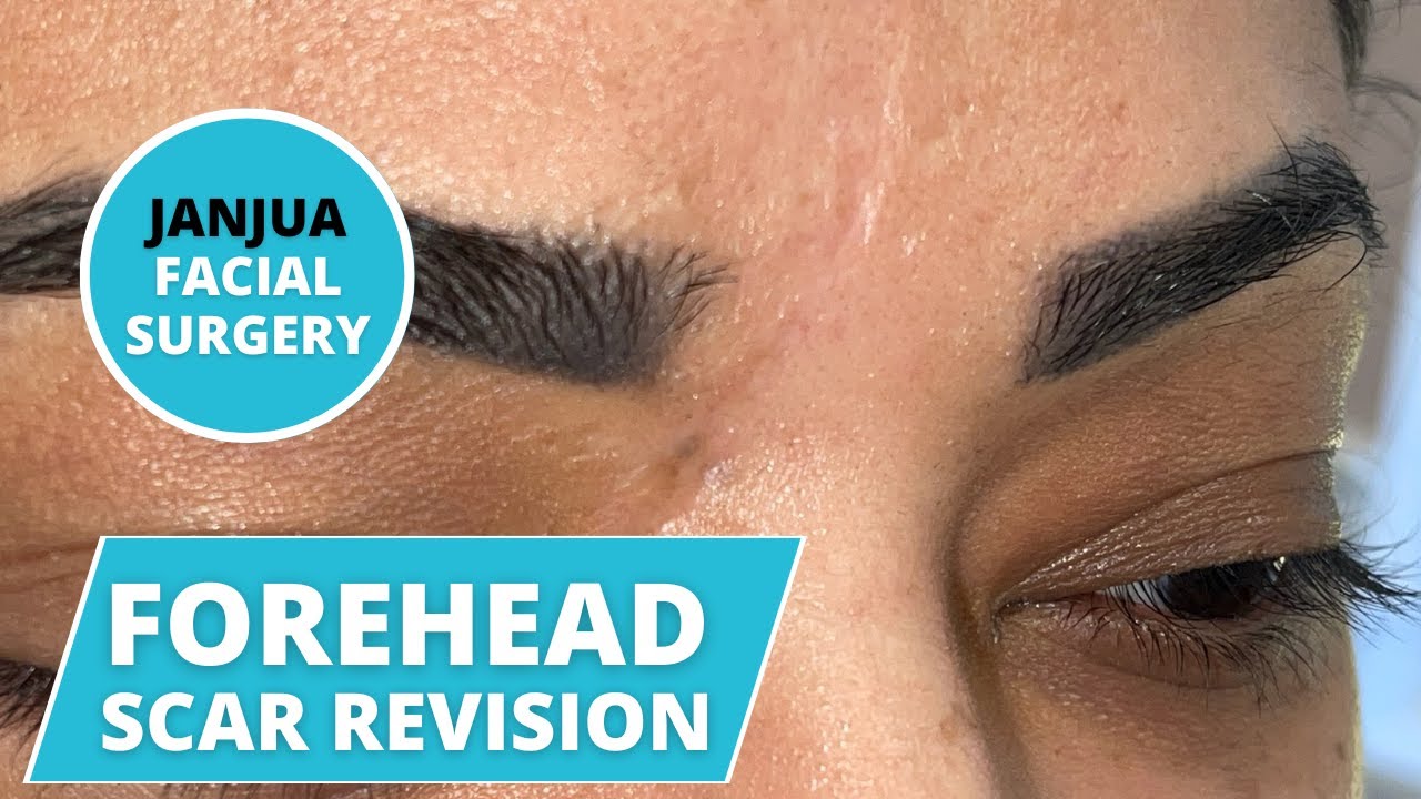 FOREHEAD SCAR REVISION ON PAKISTANI FEMALE - DR. TANVEER JANJUA - NEW ...