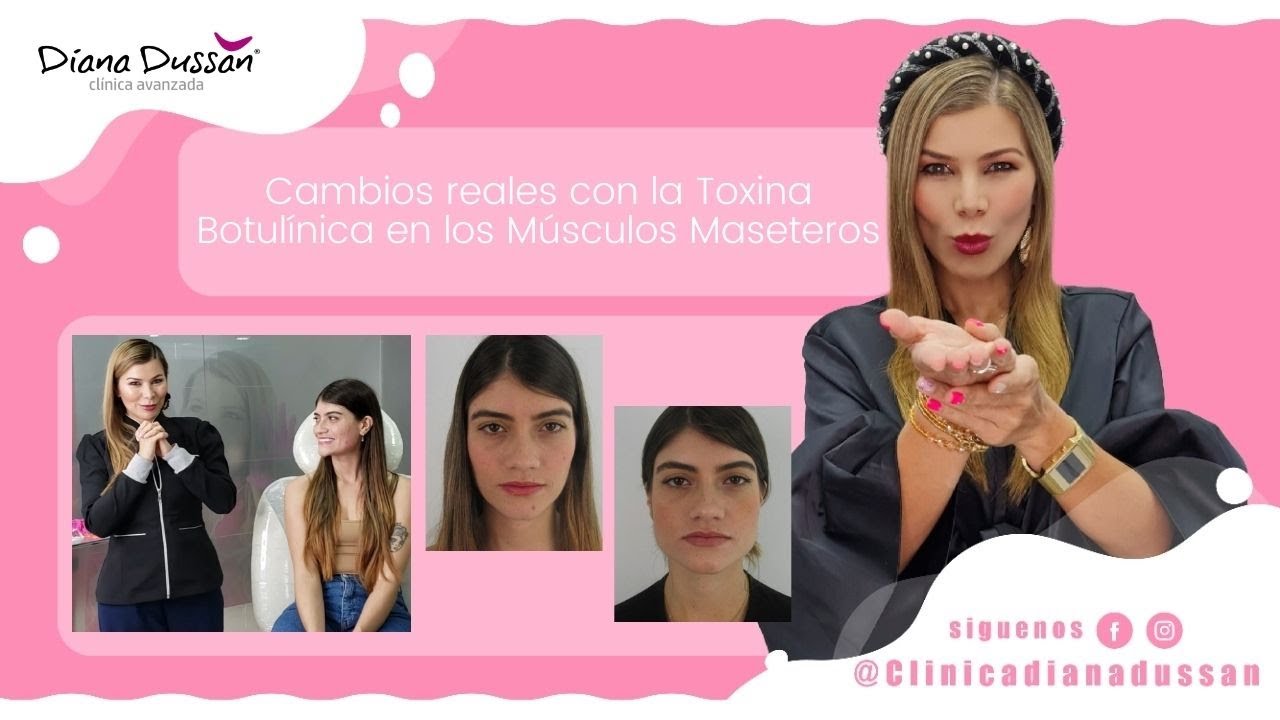💉 Cambios reales con la Toxina Botulínica en los Músculos Maseteros ...