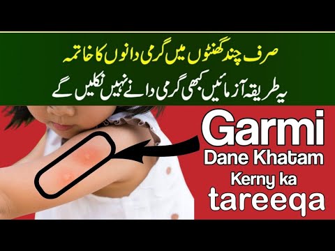 Garmi Dane Khatam Kerny ka tareeqa | Garmi Dano Ka Ilaj | Qari imamdin ...