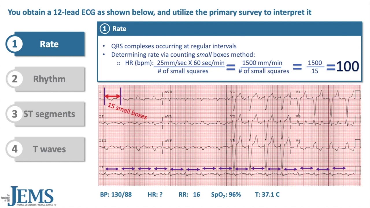 ECG Consult 39yo Firefighter Complaining of Dyspnea on Exertion - YouTube