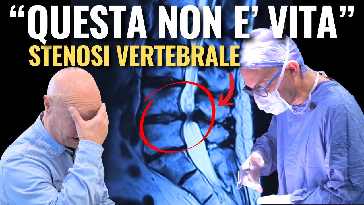 Stenosi Vertebrale Monolivello Grave: Diagnosi, Intervento ...