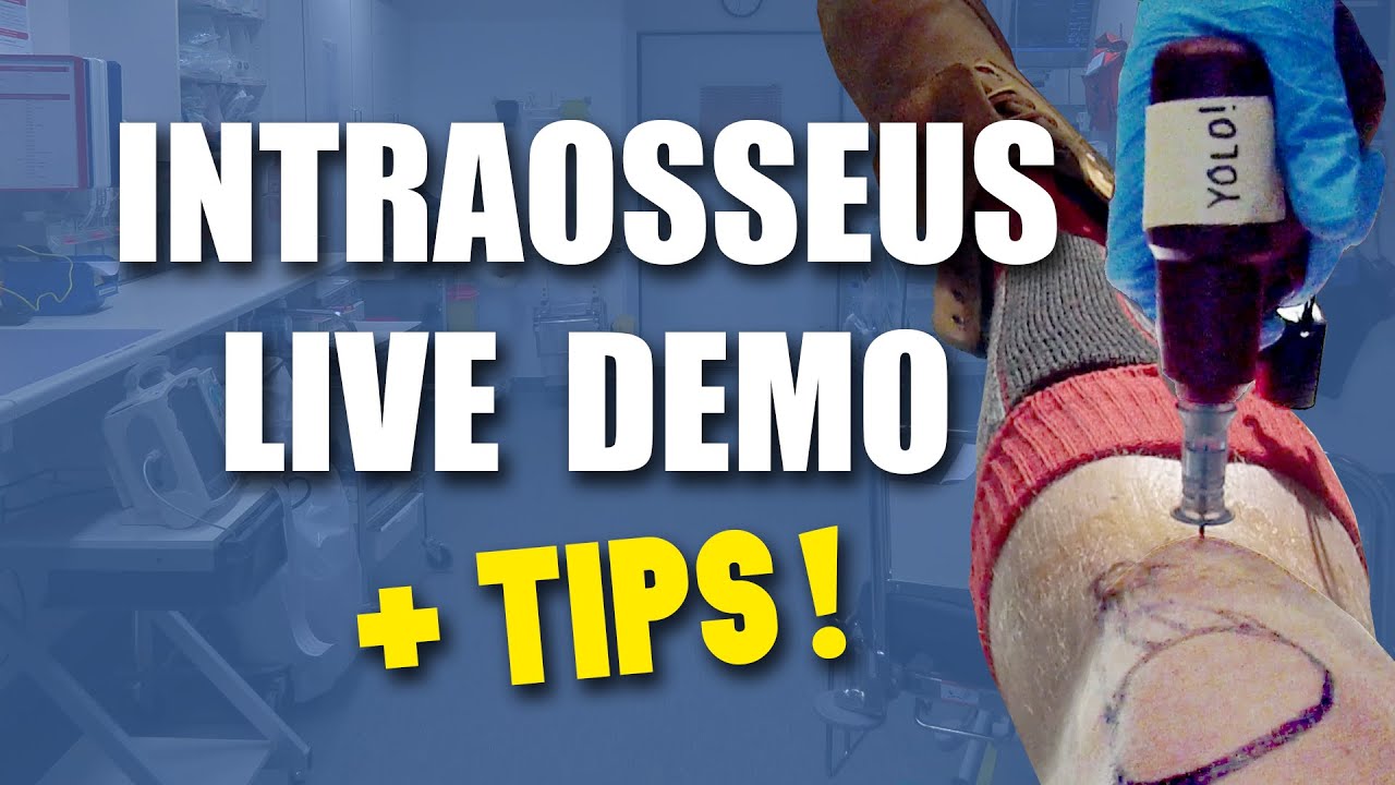 Intraosseos Live Insertion + Tips - YouTube