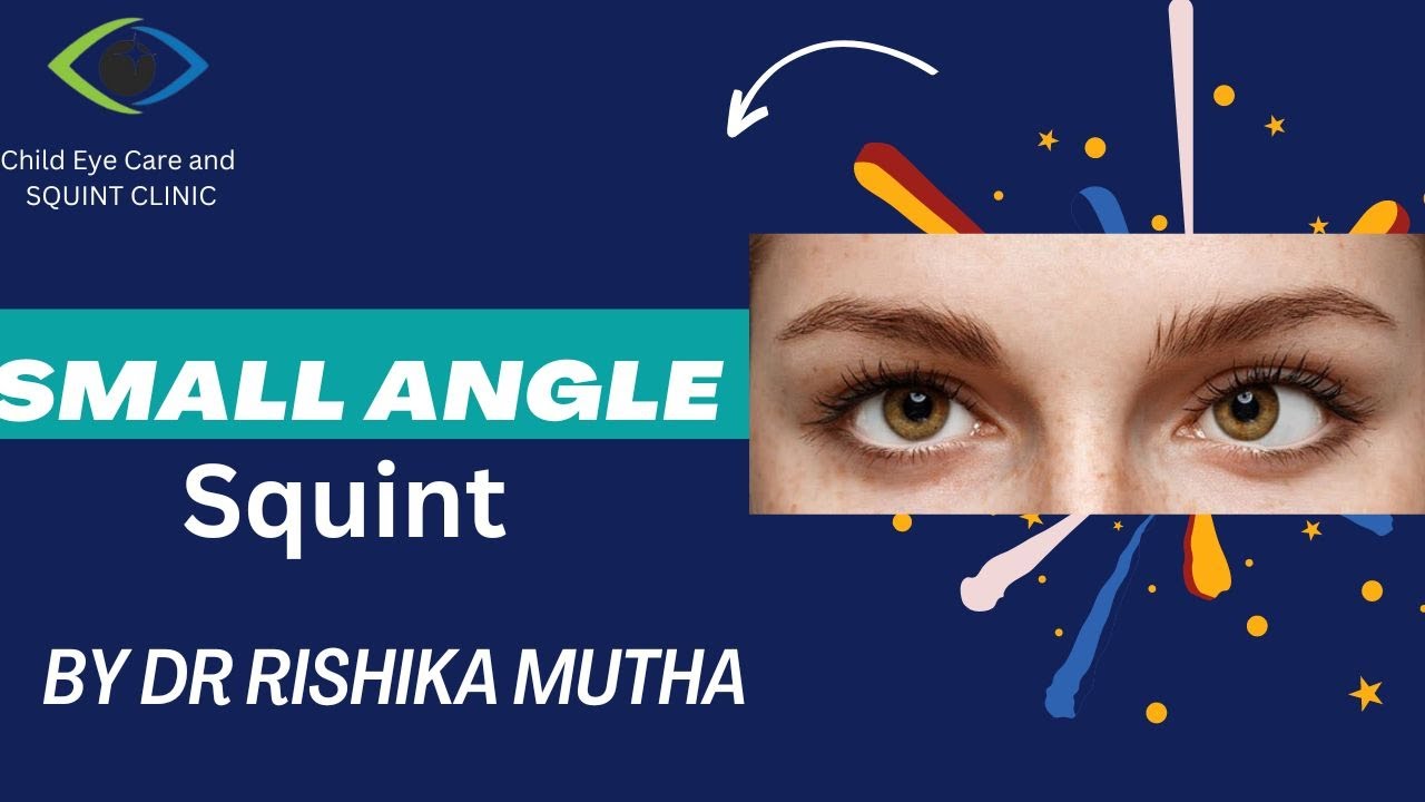 squint surgery in ratlam | Best squint treatment in ratlam - YouTube